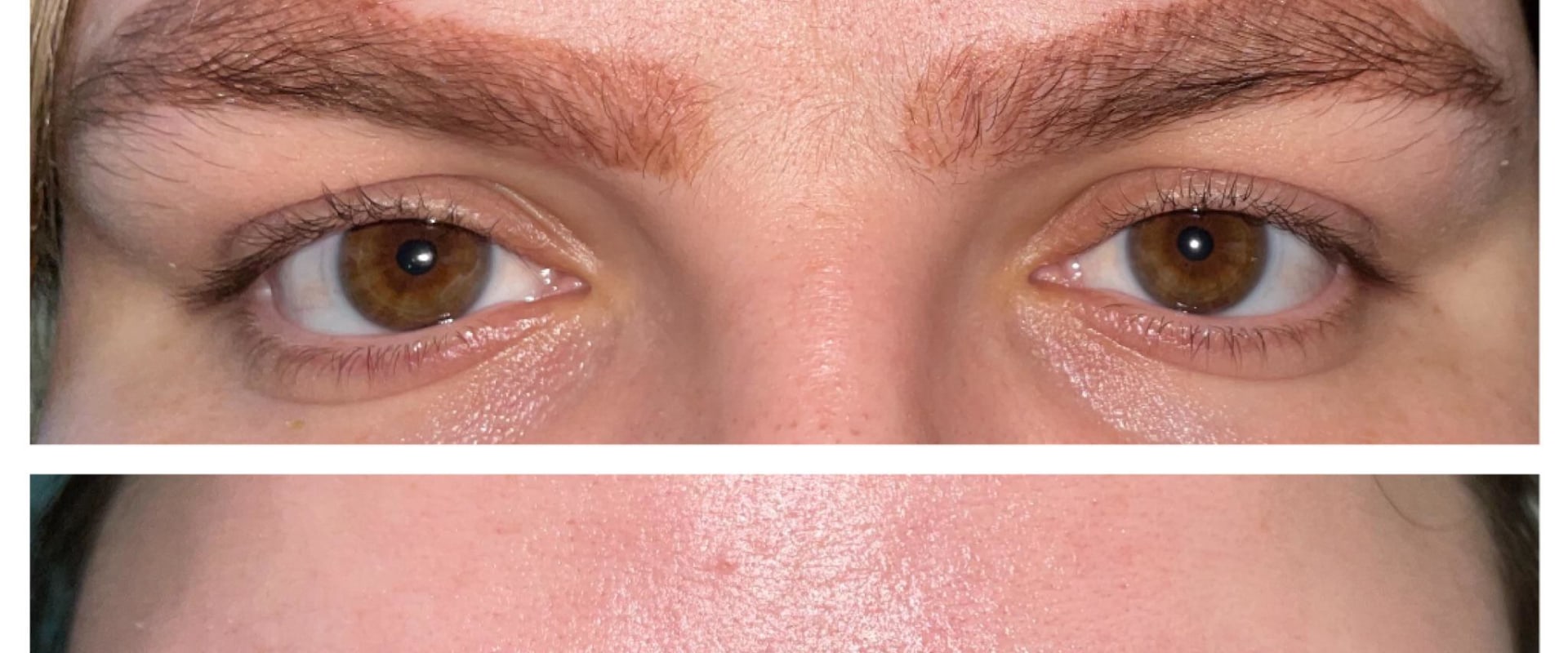 Pros And Cons Of Laser Removal For Eyebrow Tattoos