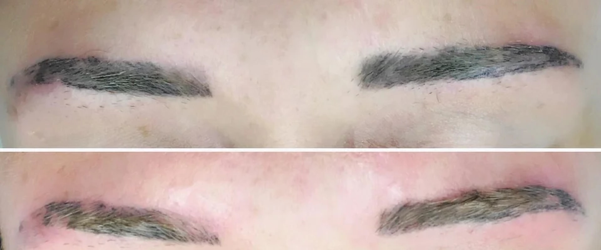 Understanding Laser Removal for Eyebrow Tattoos